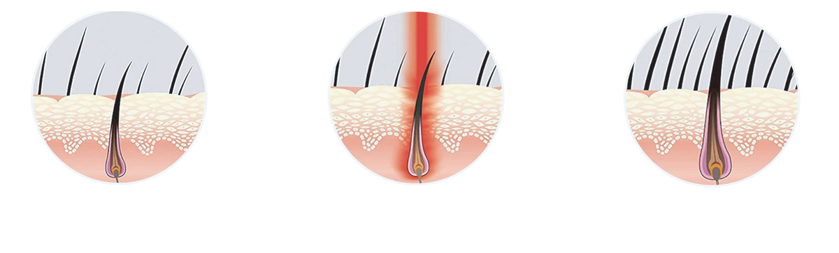 The Science Behind Hair Regrowth Laser Treatment